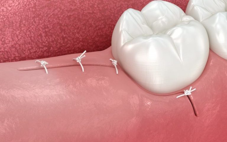 Stitches After Wisdom Teeth Extraction | Northern Virginia Oral ...